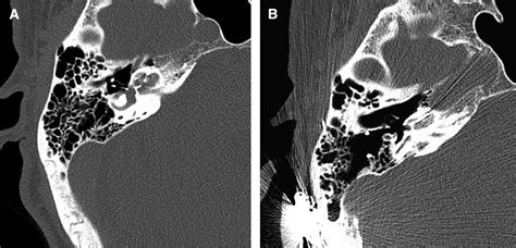Advanced Otosclerosis Otolaryngologic Clinics Of North America