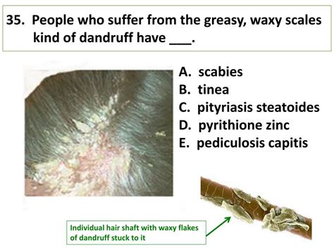 Ppt Hair And Scalp Disorders Powerpoint Presentation Free Download Id