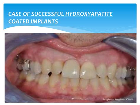 Hydroxyapatite And Their Use As Coating Material In Dentistry Pptx