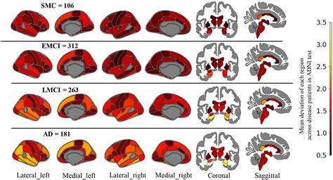 Normative Modeling Using Multimodal Variational Autoencoders To Identify Abnormal Brain Volume