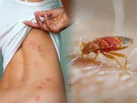 Alerta En Varias Ciudades Del Mundo Por La Plaga De Chinches Que