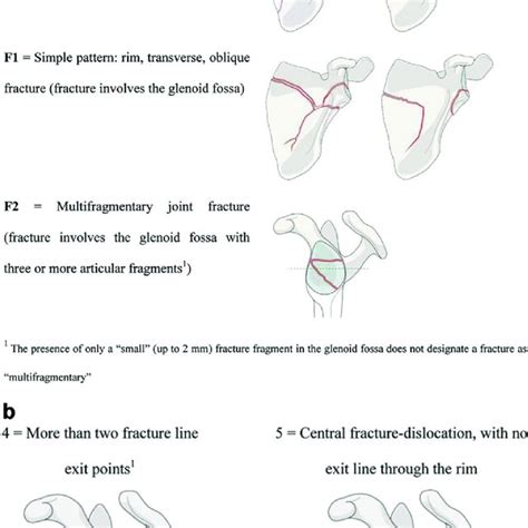 A B Arbeitsgemeinschaft Für Osteosynthesefragen Ao Glenoid