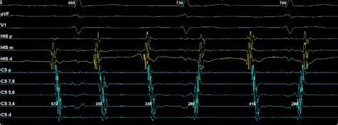 Electrogram Interpretation 21 Ep Essentials