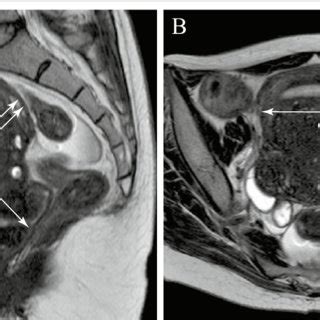 Measurement Of Uterine Size T2 Weighted Image T2wi Of Mri A We Used
