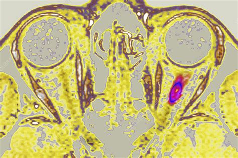 Multiple Sclerosis In The Optic Nerve Mri Stock Image C058 4687 Science Photo Library