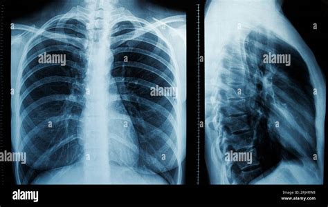 Frontal Chest X Ray Anatomy At Robert Gump Blog Frontal Chest X Ray Anatomy At Robert Gump Blog