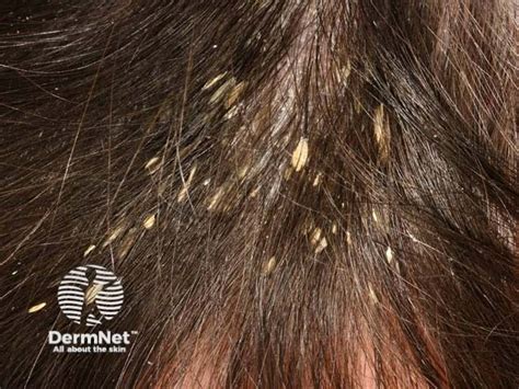 Pityriasis Amiantacea