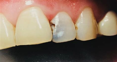 درمان کرم خوردگی دندان در خانه دانشنامه سیب