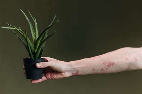Dream Of Rash Meaning And Interpretation Dreamseveryone Com
