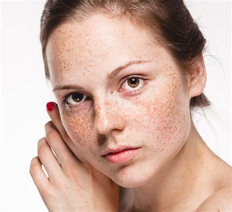 Treating Freckles Skin Conditions And Skin Concerns