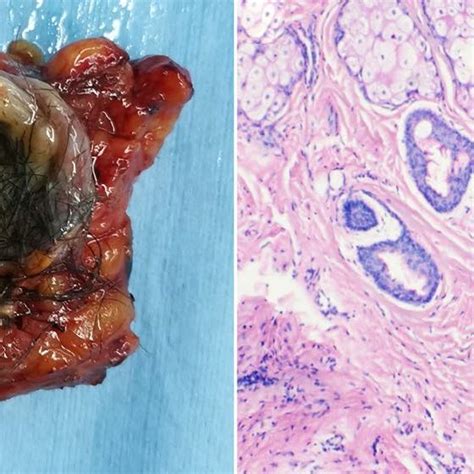 Macroscopic And Microscopic Picture Of The Tumor A Tumor Specimen