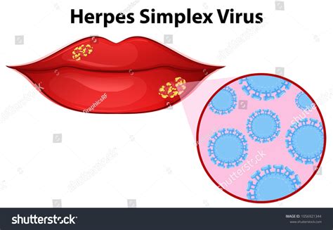 Diagram Showing Herpes Simplex Virus Illustration Stock Vector Royalty