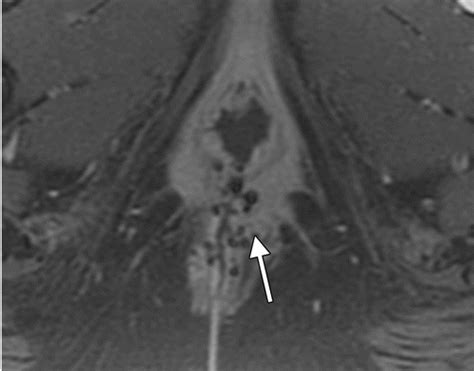 Vaginal Fissure Treatment Vulvar Pruritus—causes Diagnosis And