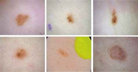 The Proposed Method Failed To Extract The Lesion Accurately Because Of