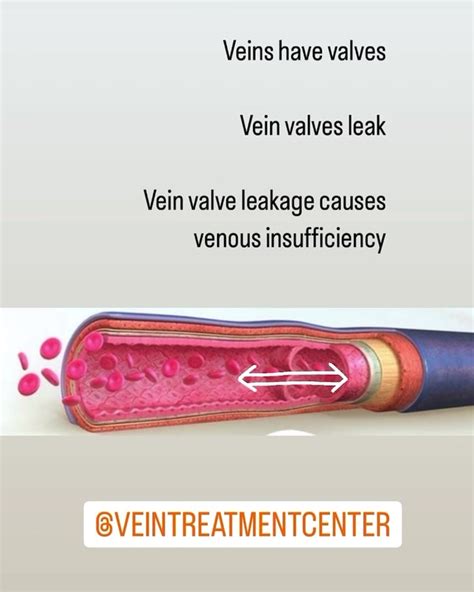 Veins Have Valves Vein Valve Leakage Causes Venous Insufficiency