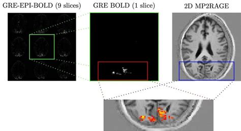 Exemplary Functional And Anatomical Localization Data From An Oblique