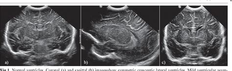 Figure 1 From Neonatal Head Ultrasound Systematic Approach To Congenital Central Nervous System