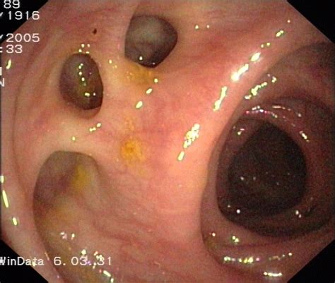 Diverticulitis Causes Diagnosis Treatment Prevention Complications