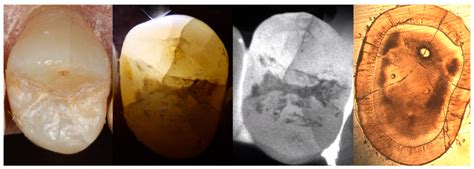 Visualization Of Cracks Using A Dental Operating Microscope
