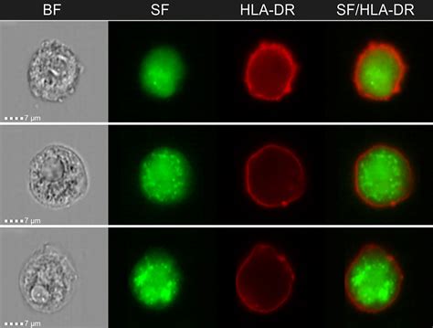 Sodium Fluorescein Uptake By The Tumor Microenvironment In Human
