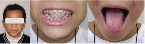 Brasil Abordagem Interdisciplinar No Tratamento Da Macroglossia Na