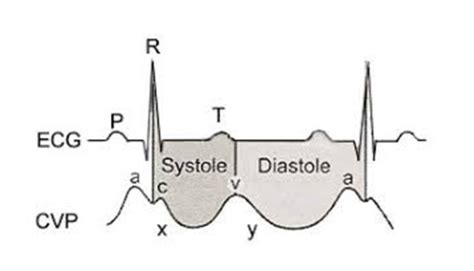 Aline Cvp Spo2 Tracing Ekg Identification Flashcards Quizlet