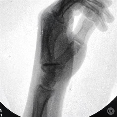 Hamate Fracture Plus 4th 5th Carpometacarpal Dislocations