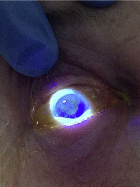 Diffuse Uptake Of Fluorescein In The Eye With Complete Ophthalmoplegia