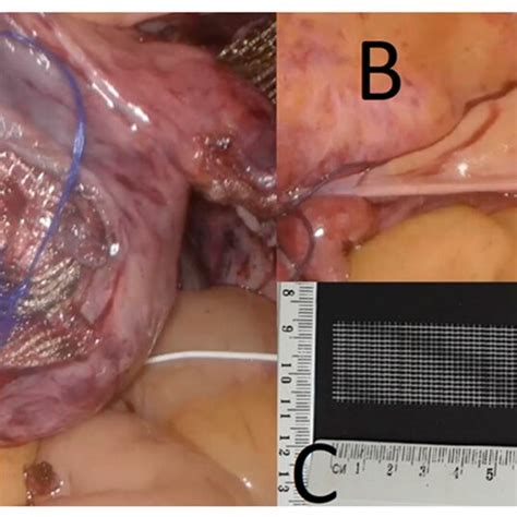 Laparoscopic Pectopexy—a Placement Of Mesh Sutured To The Vaginal