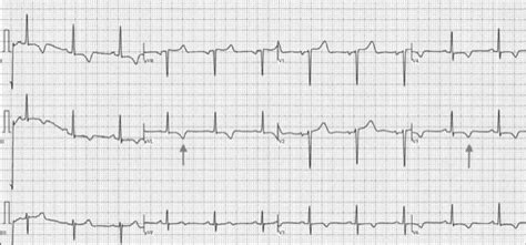 Strain As Predictor Of Outcomes Ecg Lvh Criteria Beyond Voltage Ge Healthcare Malaysia
