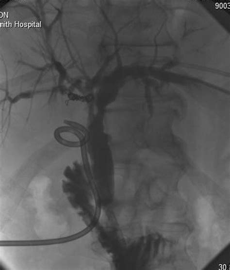 Obstructive Jaundice Due To Autoimmune Cholangiopathy Bmj Case Reports