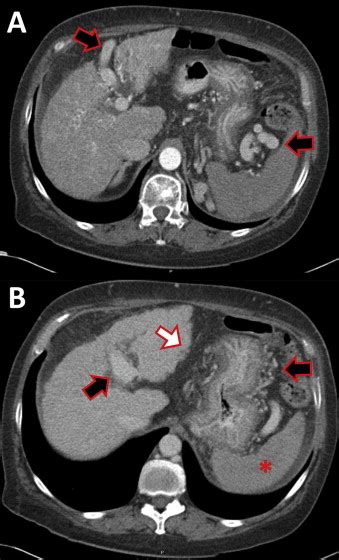 Ct Of A 58 Year Old Female Patient With Alcoholic Liver Cirrhosis