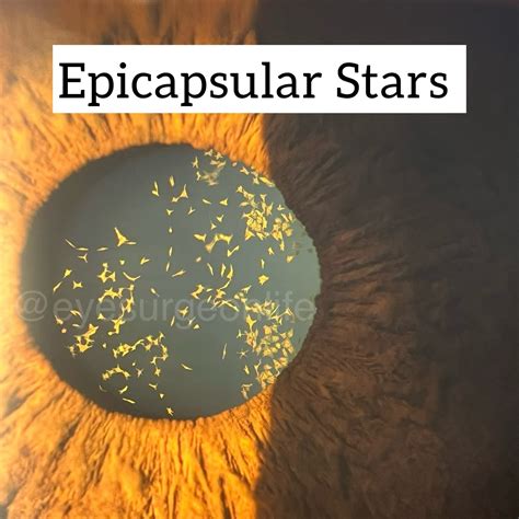 Eyesurgeonlife Eyesurgeonlife • Instagram Photos And Videos