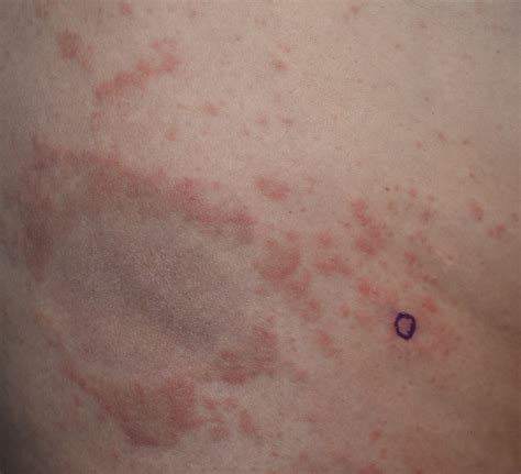 Erythema Annulare Centrifugum School Of Medicine