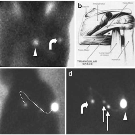 Example Of Lymphoscintigraphy Of Melanoma Of The Back With Triangular Download Scientific