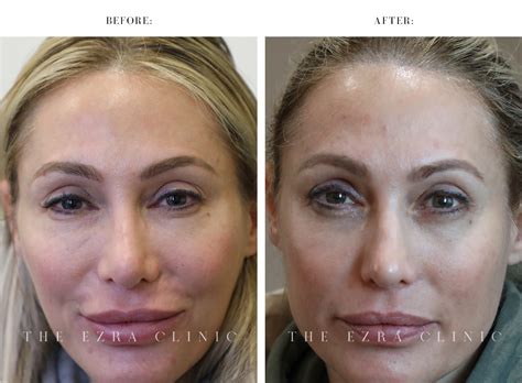 Filler Dissolving Treatment Complication Clinic In London