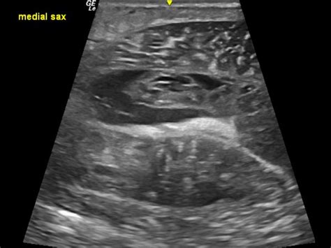 Gastrocnemius Tear Ultrasound Cases