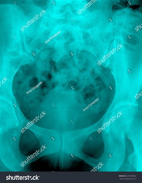 X Ray Hysterosalpingogram Hsg Foto De Stock 223768822 Shutterstock