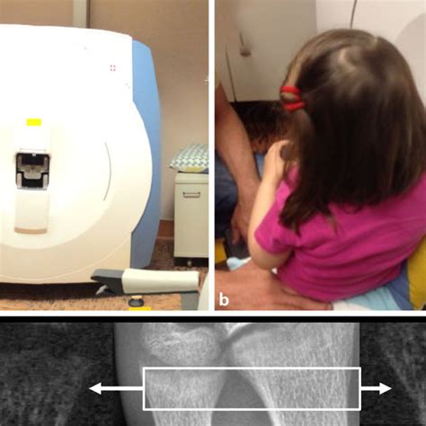 High Resolution Peripheral Quantitative Computed Tomography Hrpqct A Download Scientific
