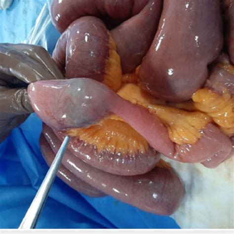 Intraoperative Image Showing The Transition Point Between Dilated