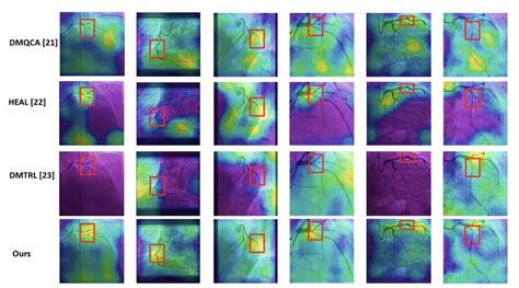marco aldinucci on linkedin aihealth ai hpcai hpc4ai aihealth ai4health angiography hpc