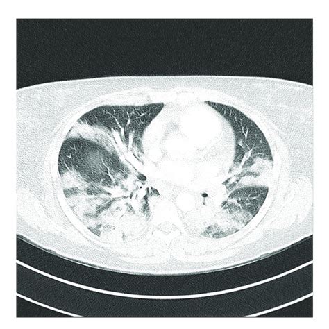 Chest Ct Showing Signs Of Acute Pulmonary Embolism Along With