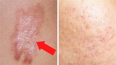 How To Get Rid Of Scars Forever DIY Joy