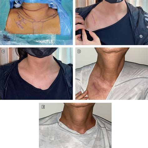 The Incisions Of Gasless Endoscopic Thyroidectomy Via Anterior Chest Download Scientific