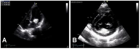 Echocardiographic Study A Apical Fourchamber View Echo Dense Tumor