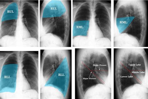 Right Lung Anatomy Lung Lobes Lunges Medical School Stuff