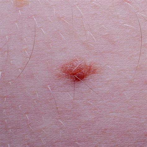 Nevus Or Mole On The Human Body Close Up Skin Cancer Keratosis Or Melanoma On The Skin Stock