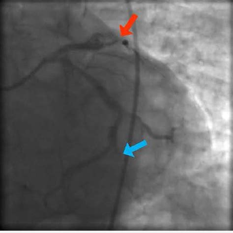 Result Of The Angioplasty Of The LAD I LAD II And OM2 Branch With Download Scientific Diagram