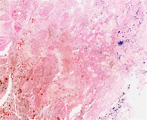 Acute Pancreatitis Gross