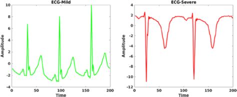 Example Of Ecg Waveforms Amplitude Versus Time From Two Randomly